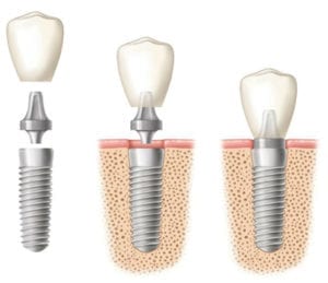 Swelling Around Dental Implants? What you and your dentist can do ...